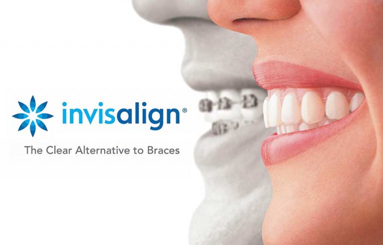 Invisalign Teen: 5 Things Parents Need to Know - Silver Smile Dental